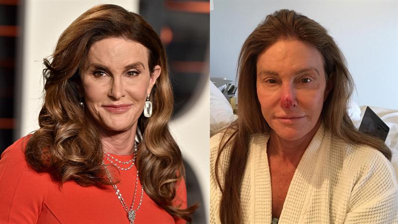 Caitlyn Jenner Debuts Scarred Nose After 'Sun Damage' Removal | Access